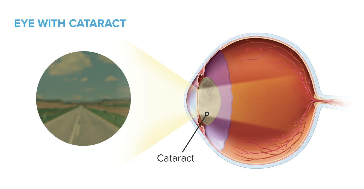 Cataract Surgery Athol | Cataract Surgery Greenfield | Eye Center